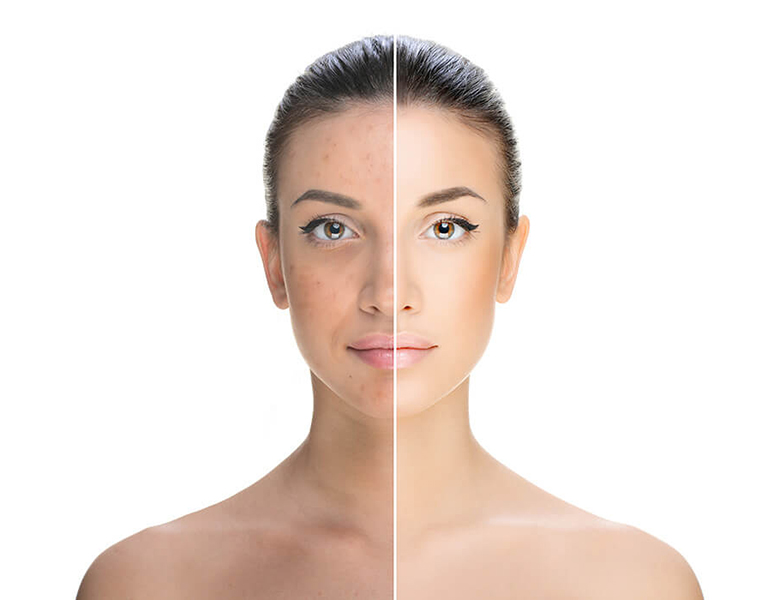 Skin Peels - Nine Elms Clinic